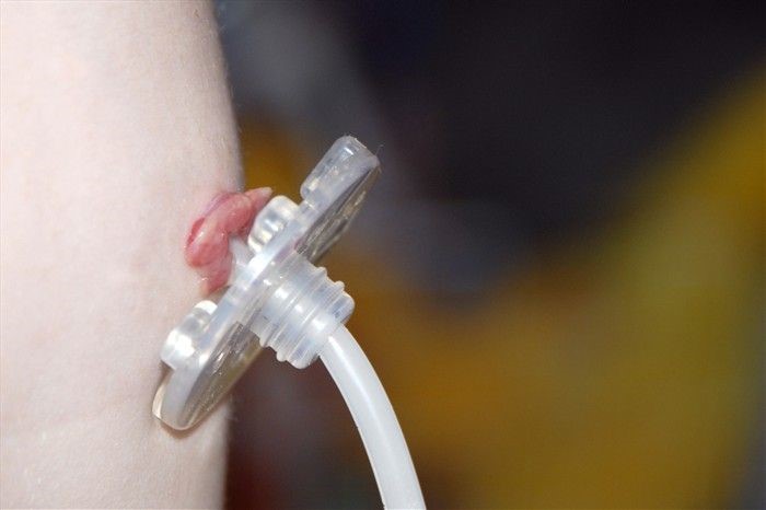 Cleaning Feeding Tubes 101 – The Tube Feed Dietitian